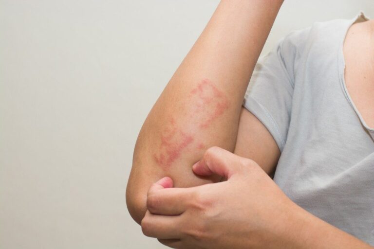 Rash on Arm Causes: Itchy, Red, Treatments, and Remedies - American Celiac