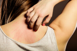 Boils on Back Causes, Huge, Recurring and Treatments - American Celiac