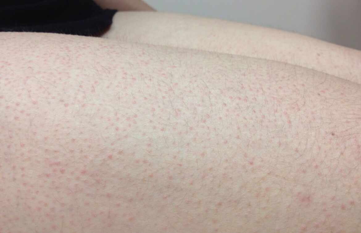 Red Painful Rash Bumps on Thighs Causes and Treatments - American Celiac