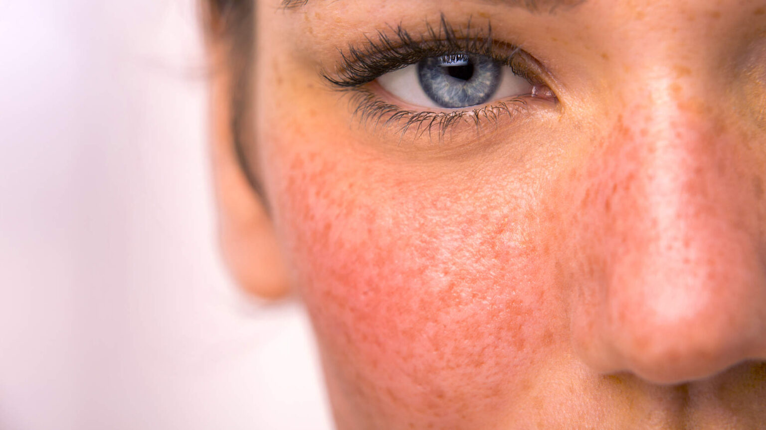 Itch or Non-Itchy Red Face Rash Causes and Treatments - American Celiac