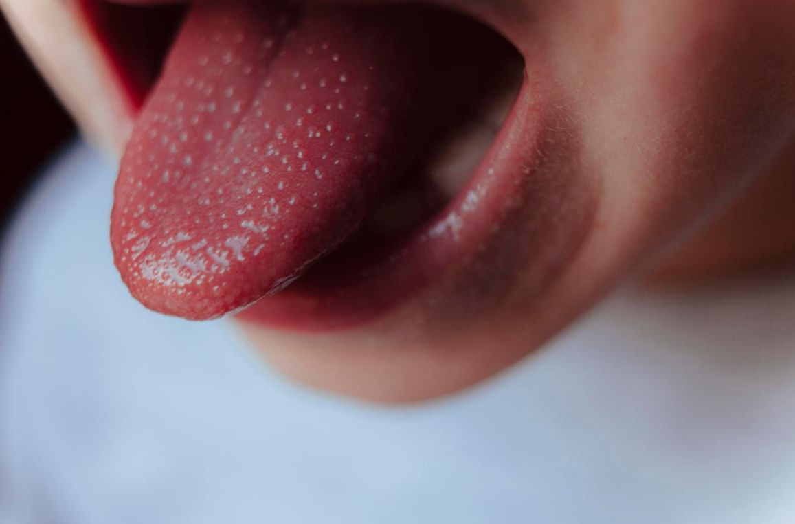 Tongue Blisters Causes: Red, White, Small, Painful and Cures - American ...