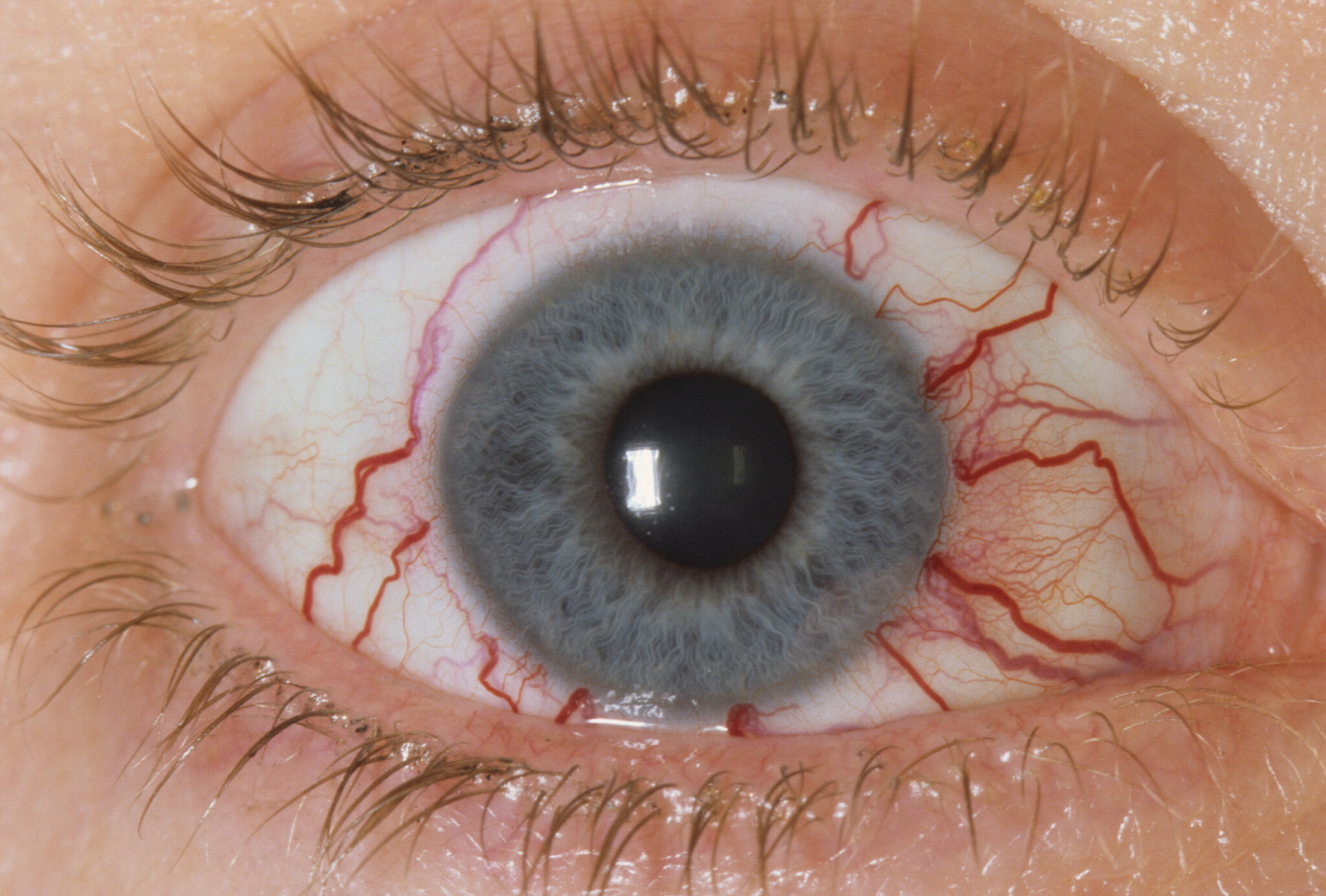 Red Ring Around Iris, Eyelids, Eye Socket, In Babies & More - American ...