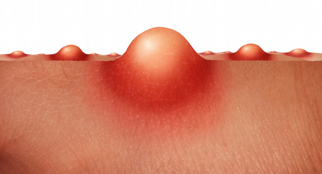 Boils on Back Causes, Huge, Recurring and Treatments - American Celiac