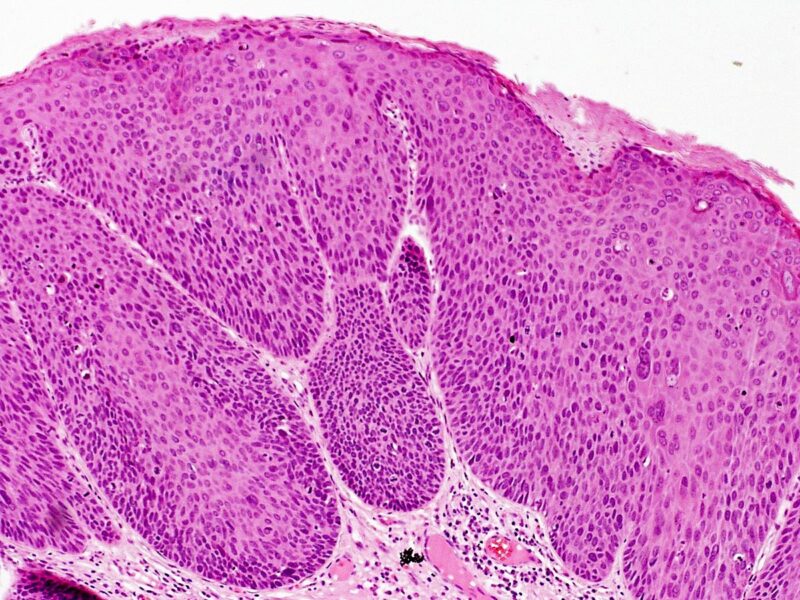Penile Lesions Causes: Cancer, Herpes, Warts or STDs? - American Celiac
