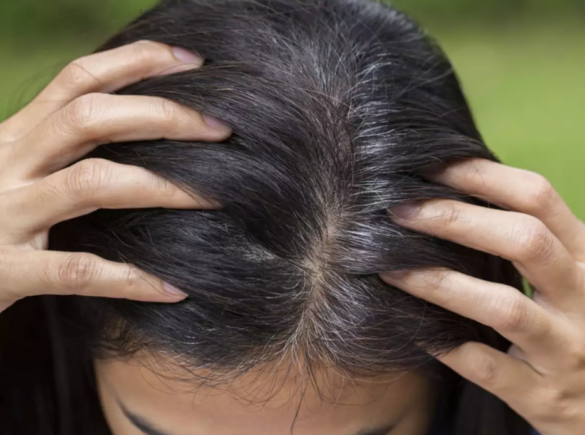 Sores on Scalp Causes, with Hair Loss and Treatments - American Celiac