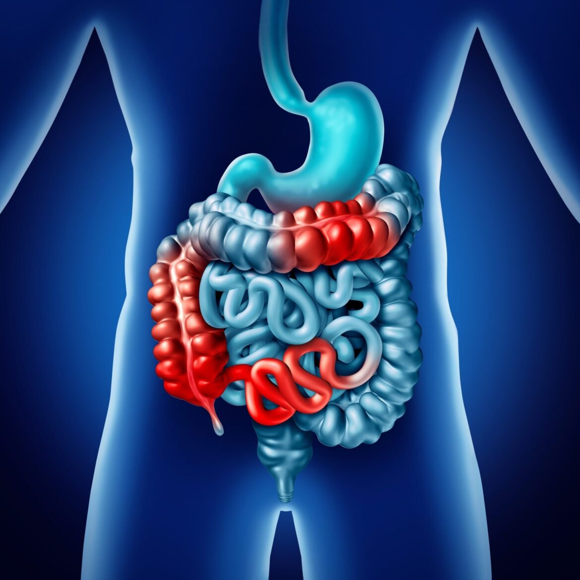 Left, Right Swollen Colon Causes, with Bloody Stools Cures - American ...