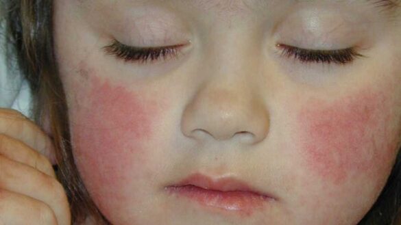 Swollen Cheeks Causes, Red, In Toddler and Inside Mouth - American Celiac