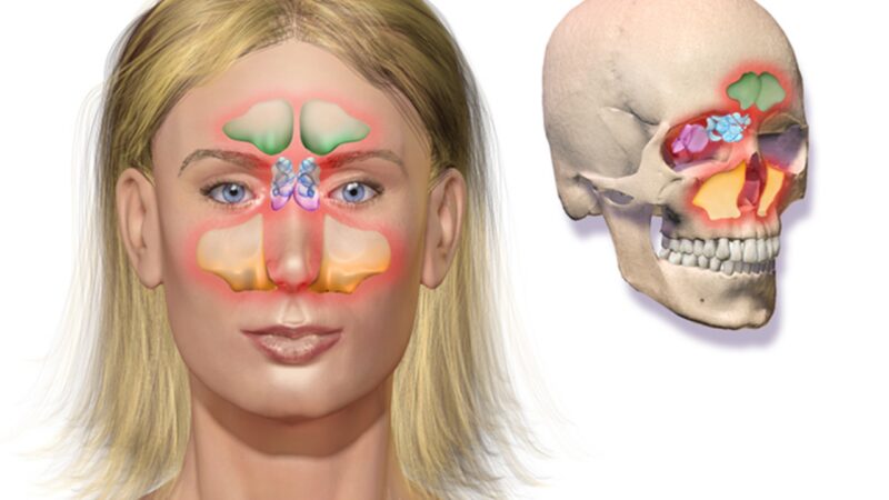 Nose Infection, Inside, Symptoms, Treatments and Cause - American Celiac