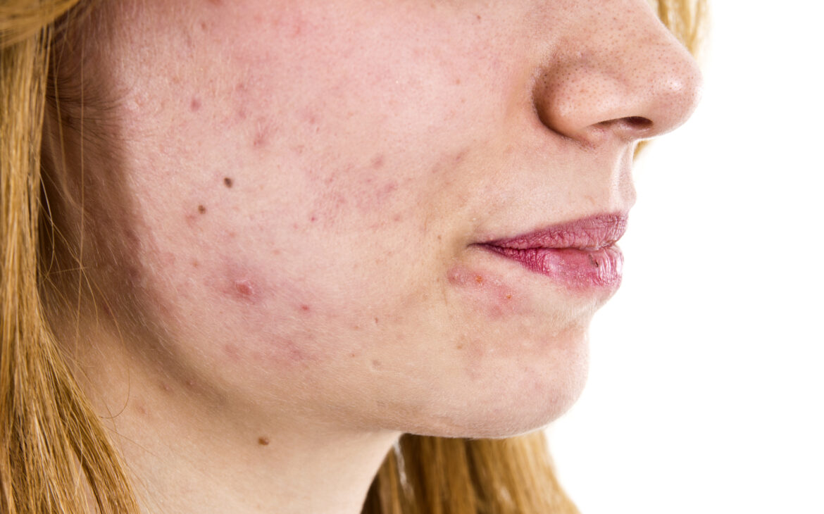 Scabs on Face Meaning, Symptoms, Causes and Getting Rid of Them Fast ...