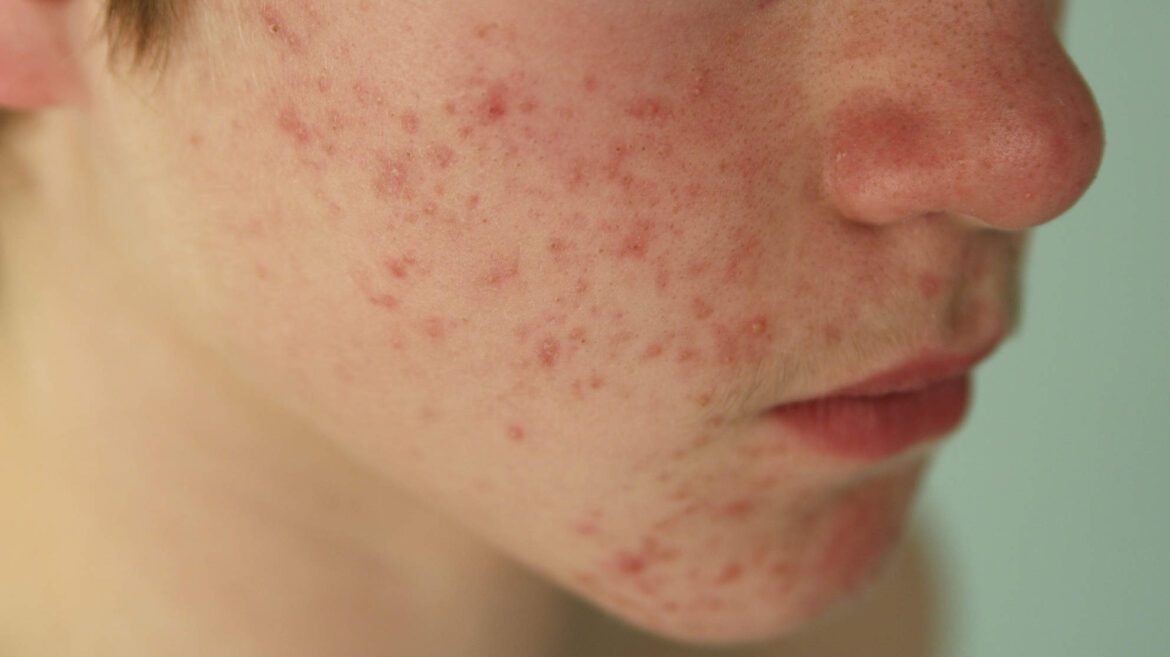 Scabs on Face Meaning, Symptoms, Causes and Getting Rid of Them Fast ...