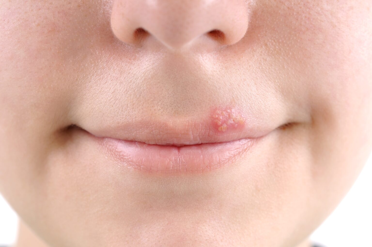 Swollen Upper Lip Causes, Symptoms, Sudden and Top Lip Swelling ...
