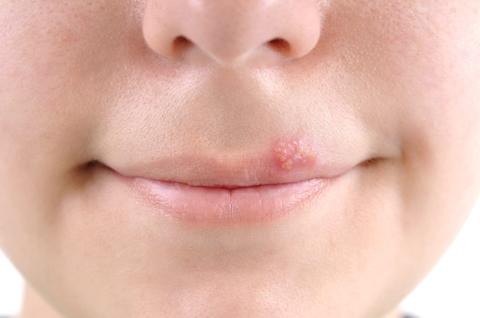 Swollen Upper Lip Causes, Symptoms, Sudden and Top Lip Swelling ...