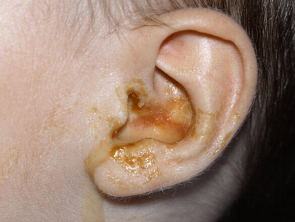 Itchy Ears – Inside Ear Canal Meaning, Causes, Allergies, Treatment ...