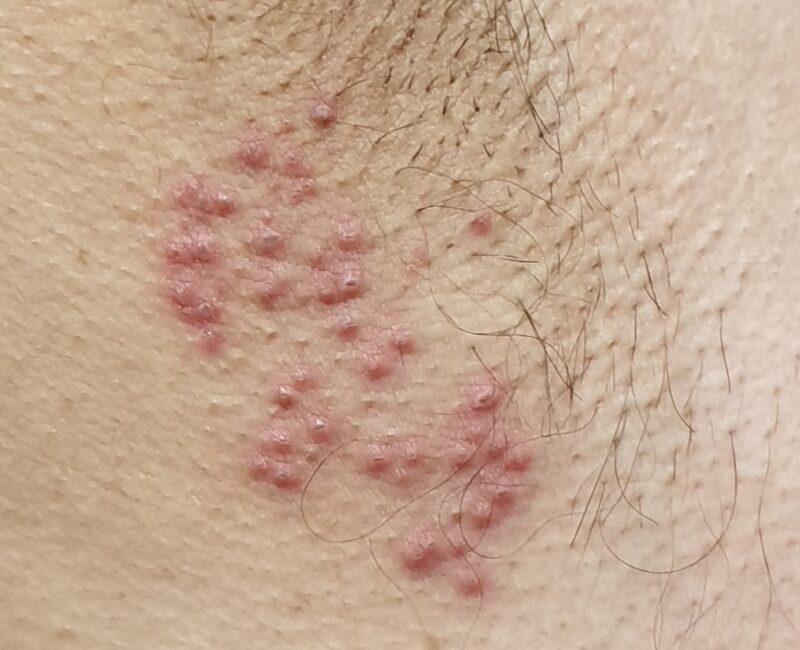 Underarm Pain Causes – Left, Right, Breast, & Sharp Shooting Pain under ...