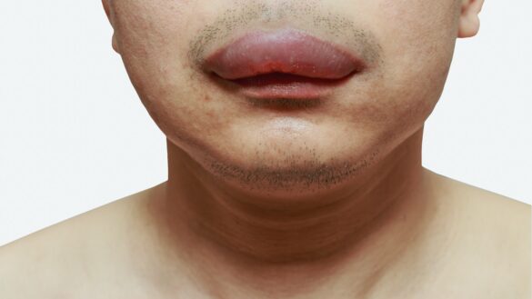 Swollen Upper Lip Causes, Symptoms, Sudden and Top Lip Swelling ...