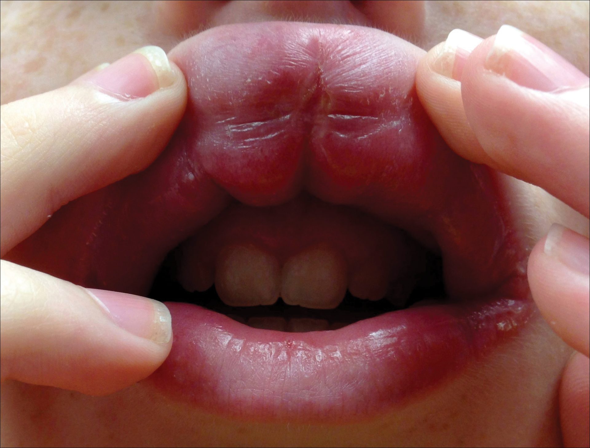 Inside Of Upper Lip Swollen
