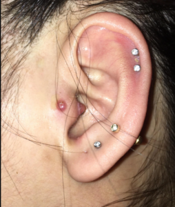 Infected Tragus Piercing Signs, Bump, Risks and How to Treat It ...