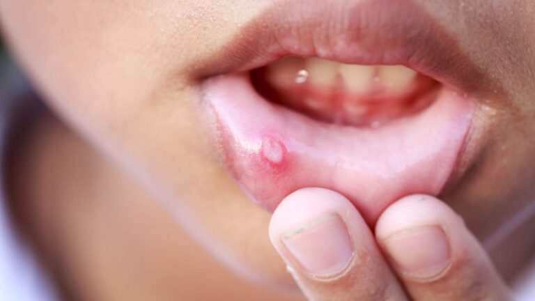 White Spots on Lips Causes, Pictures, Small, on Lower, Upper, Inside ...