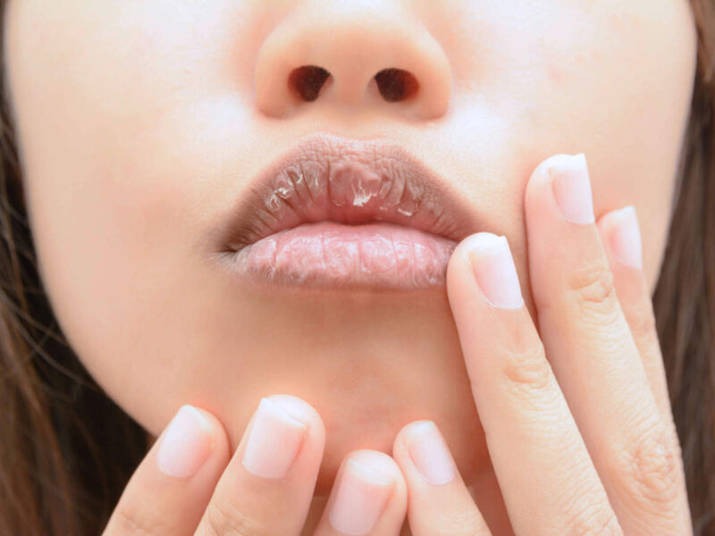 How to Get Rid a Swollen Lip, Heal, Treat and Reduce Lip Swelling ...