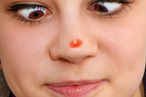 Pimple on Nose Causes, How to Get Rid of Big, Cystic Pimple on Nose ...