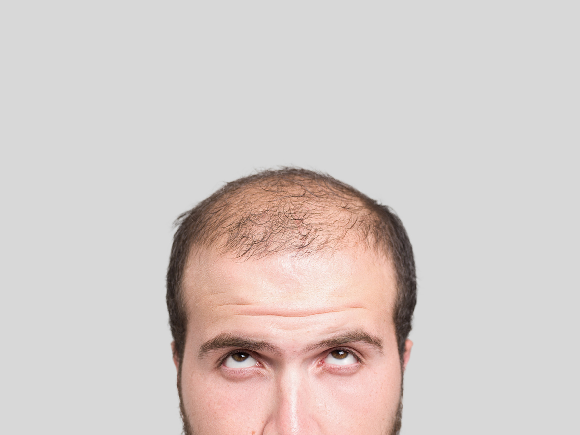 Receding Hairline Meaning, Types, Causes, Regrowth Treatments and ...
