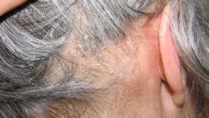 Crusty Behind Ears Causes, Symptoms, Dry Skin, Psoriasis, Skin ...