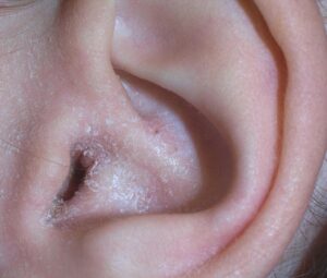 Crusty Behind Ears Causes, Symptoms, Dry Skin, Psoriasis, Skin ...