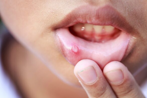 Bumps Inside Lips Causes, Small, Clear, White or Red Bumps Treatments ...