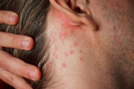 Crusty Behind Ears Causes, Symptoms, Dry Skin, Psoriasis, Skin ...