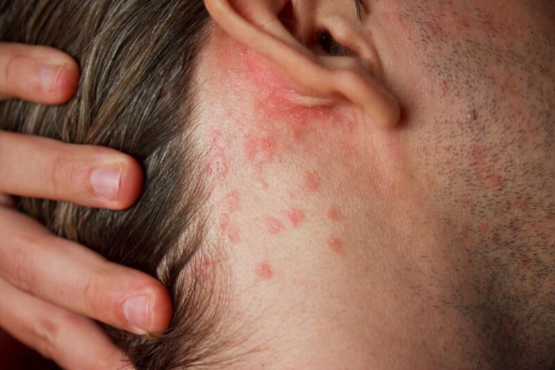 Crusty Behind Ears Causes, Symptoms, Dry Skin, Psoriasis, Skin ...