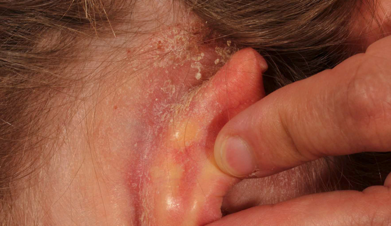 Crusty Behind Ears Causes, Symptoms, Dry Skin, Psoriasis, Skin ...