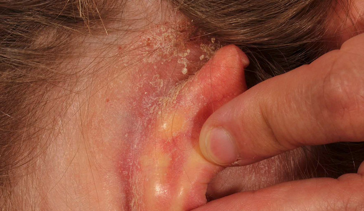 Crusty Behind Ears Causes, Symptoms, Dry Skin, Psoriasis, Skin ...
