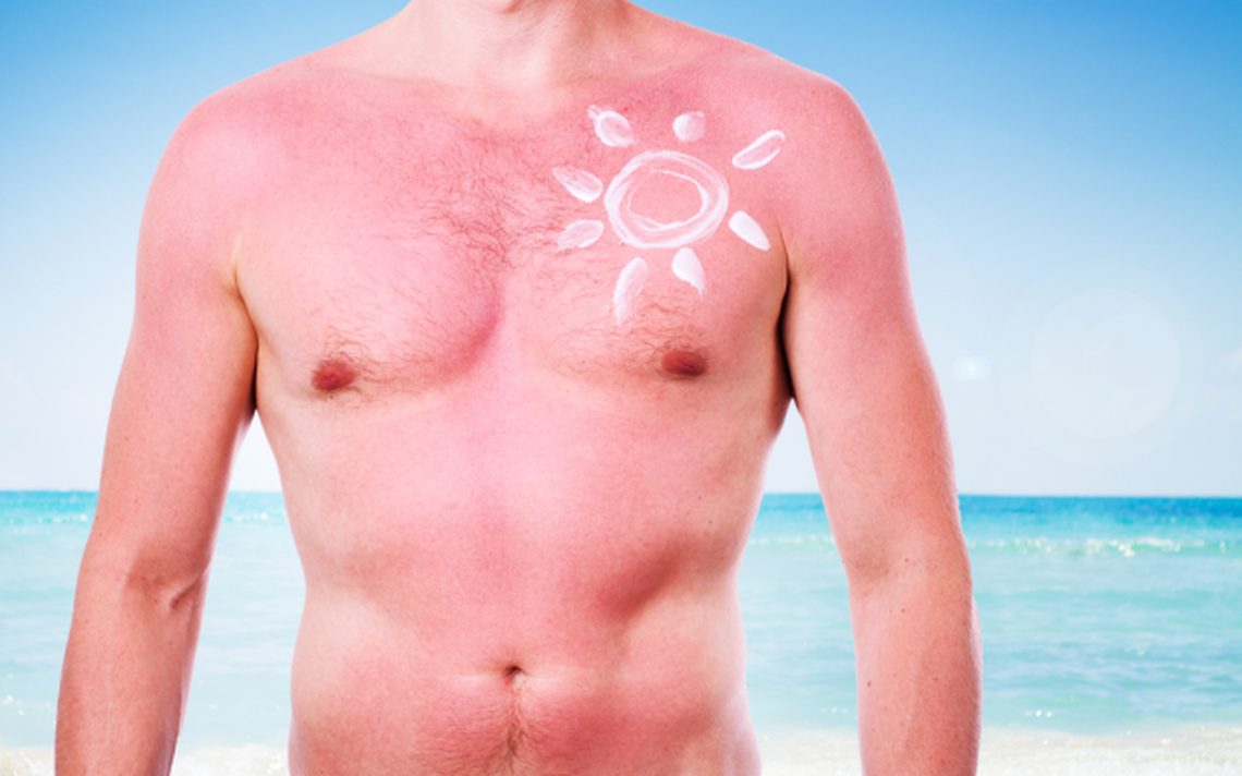 How to Stop Sunburn Itch, Pain Including Home Remedies - American Celiac