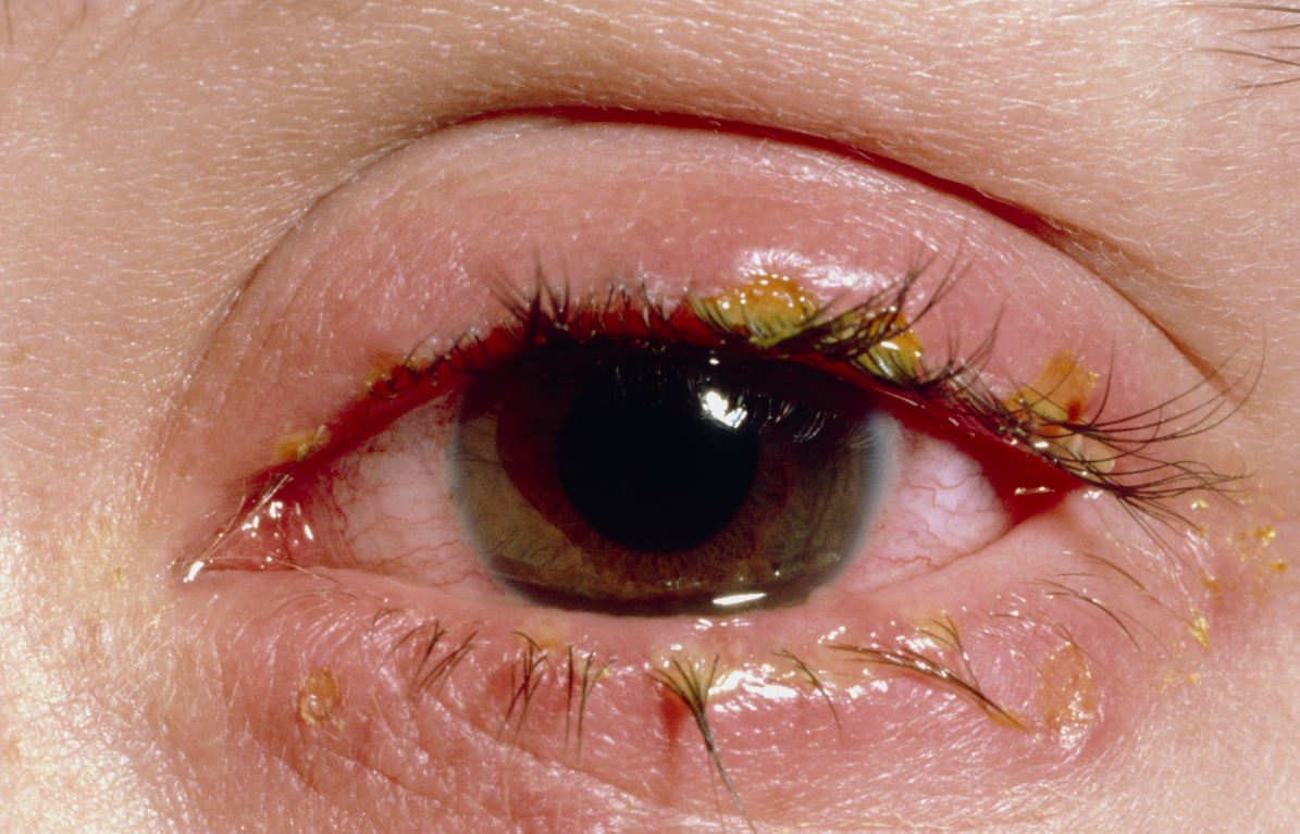 Eyelid Redness Causes, Symptoms, Inflamed, Dry Itchy Swollen Red ...