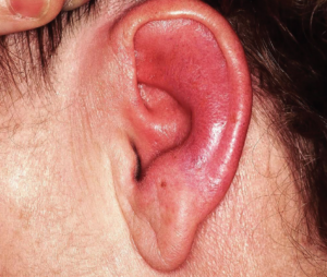 Swollen Ear Lobe Causes, Piercing, Abscess, Infection & Treatment ...