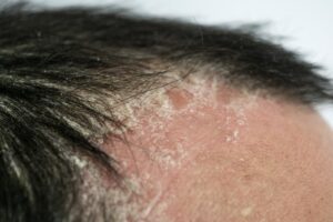 Smelly Scalp Causes, Symptoms, Treatments, Home Remedies for Scalp Odor ...