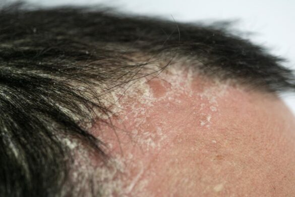 Smelly Scalp Causes, Symptoms, Treatments, Home Remedies for Scalp Odor ...