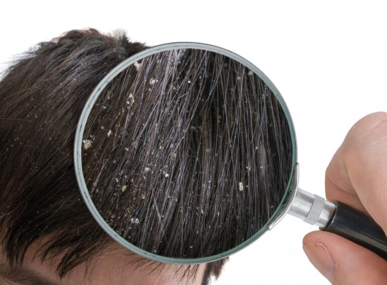 Smelly Scalp Causes, Symptoms, Treatments, Home Remedies for Scalp Odor ...