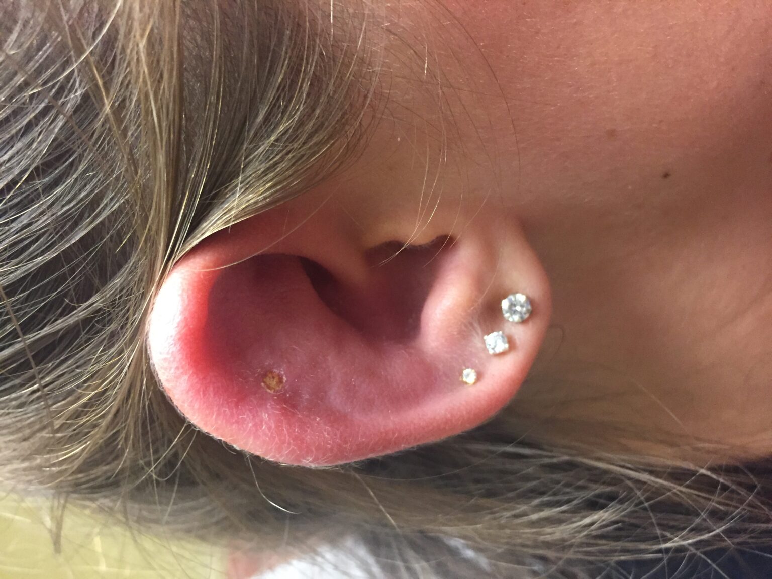 Piercing Infection Care, Cleaning, Treatment, Signs and Symptoms ...