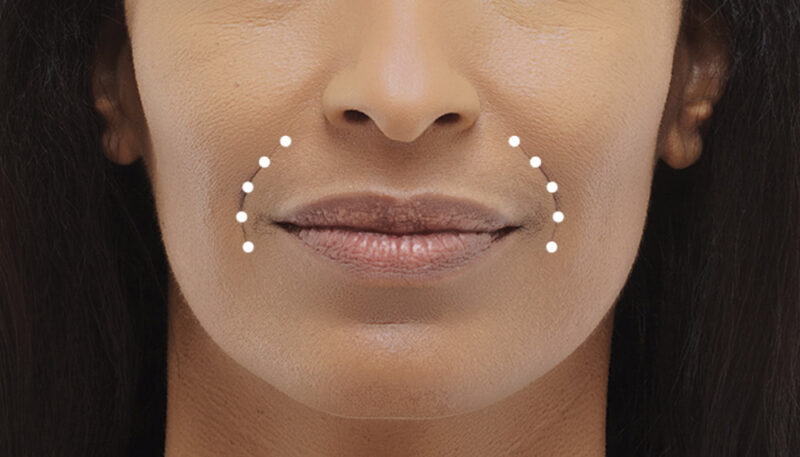 Smile lines Causes and How to Get Rid of Smile Lines Permanently ...