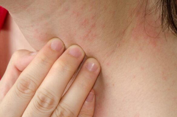 Rash on Neck Meaning, Causes, Itchy, Red, Bumpy Rash, Diagnosis and ...