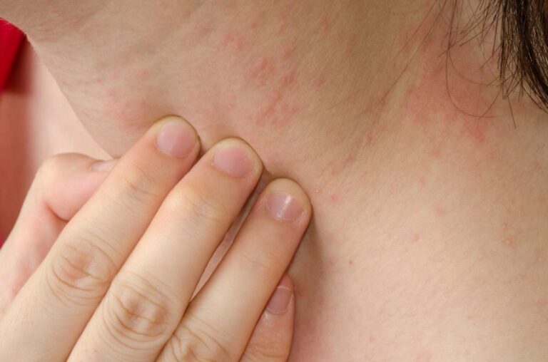 Rash on Neck Meaning, Causes, Itchy, Red, Bumpy Rash, Diagnosis and ...