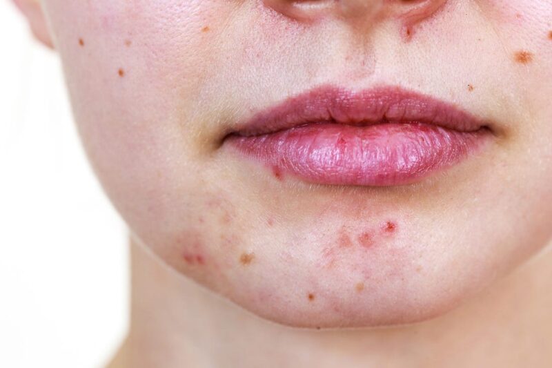 Chin Acne Causes, Painful, Hormonal, Around under Chin & Treatments ...