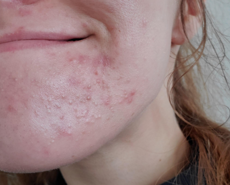 Chin Acne Causes, Painful, Hormonal, Around under Chin & Treatments ...