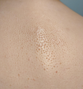 Boils on Back Causes, Symptoms, Large, in Babies, Reccurring, Pictures ...