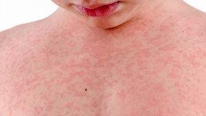 Rash on Chest Pictures, Causes, Symptoms, Remedies and Treatment ...
