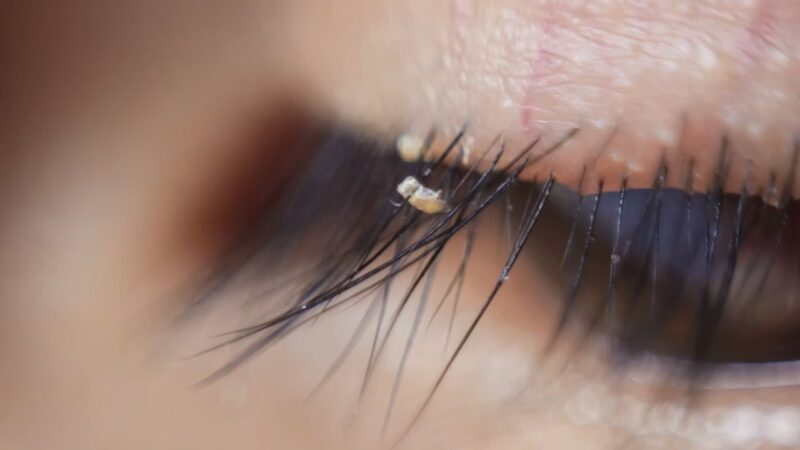 Eyebrow Mites Pictures, Facts, Symptoms and Treatments of Domedex ...