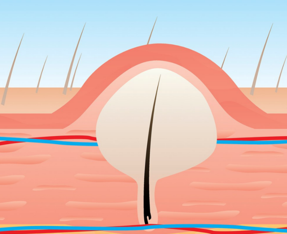 Infected Ingrown Hair Cysts Symptoms, Pictures, Causes on Thighs, Neck ...