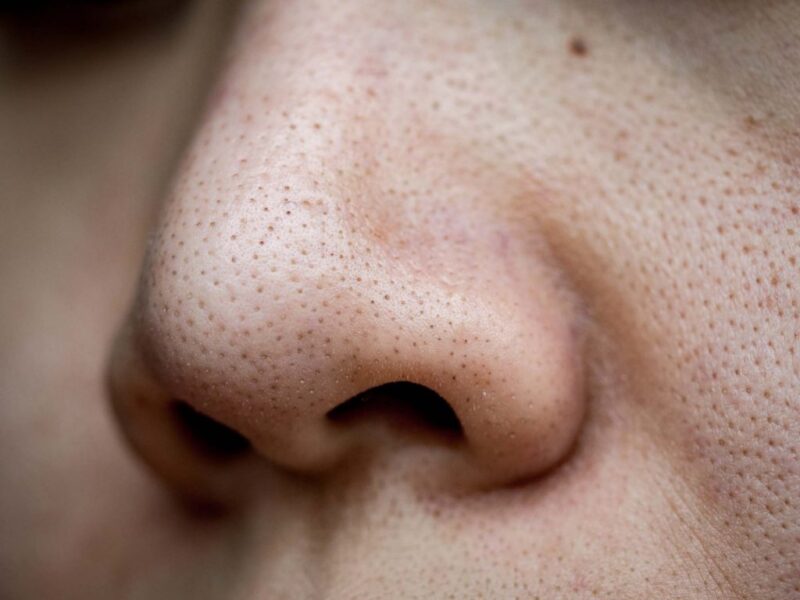 Large Pores on Nose, Big, Enlarged – How to Get Rid, Treat or Shrink ...