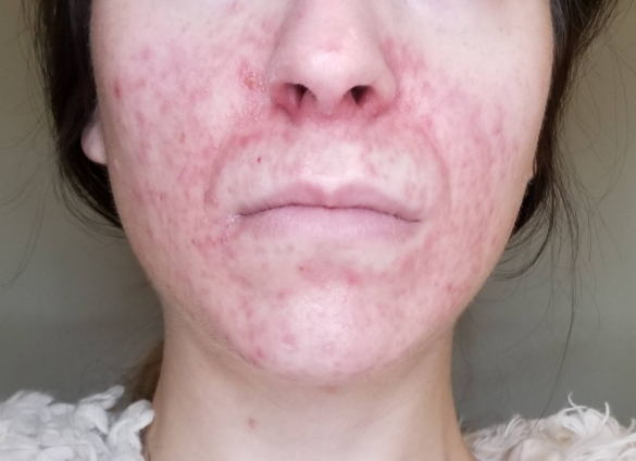 Redness around Nose Causes and How to Get Rid of Red, Dry Skin on Nose ...